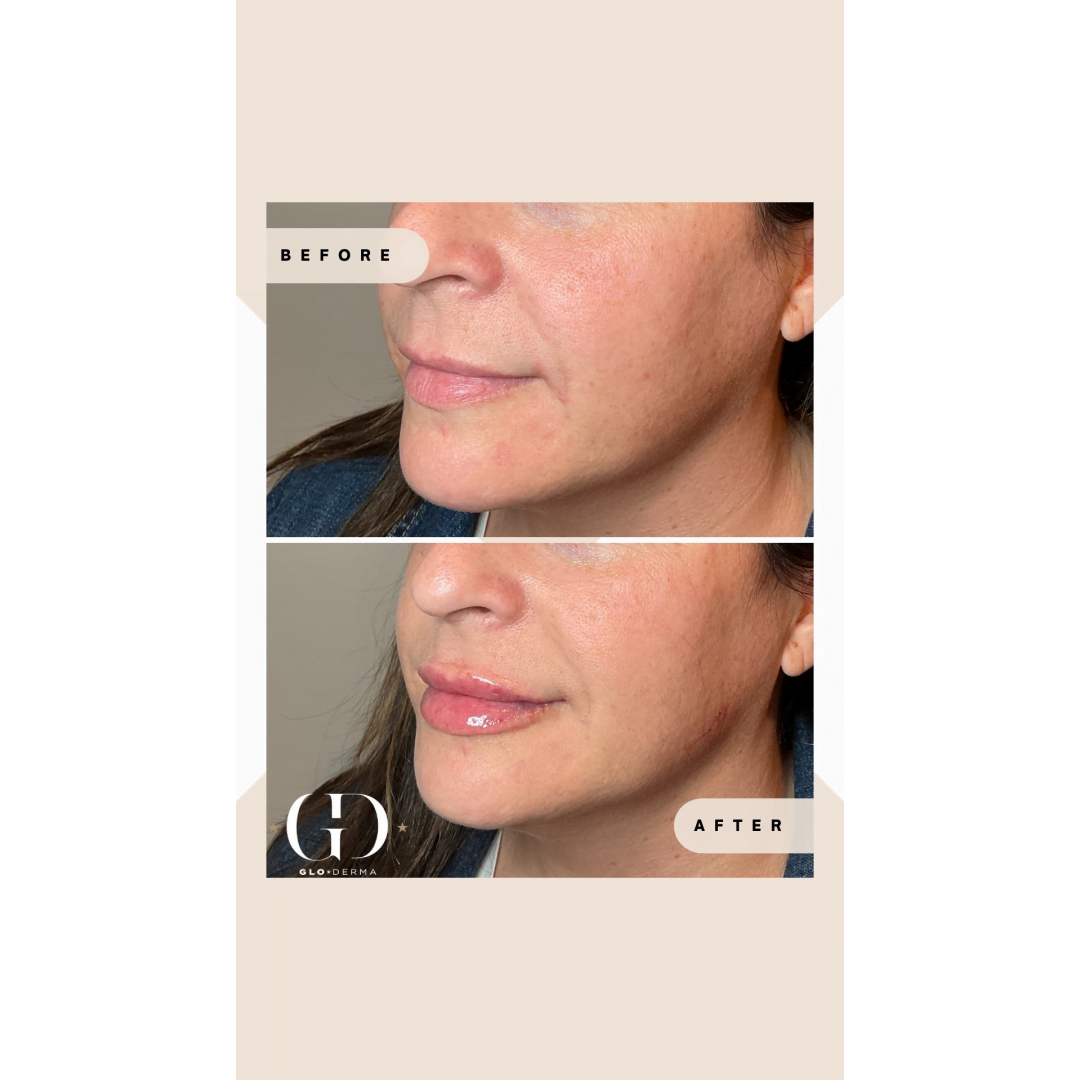Before & After Treatment Images Of Glo Derma | Bucks County, PA